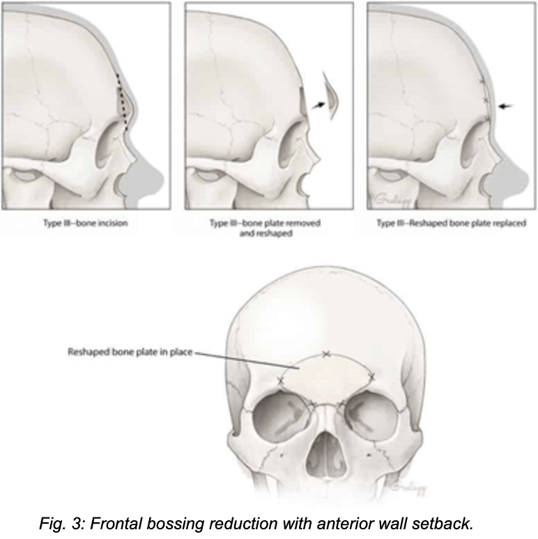 Forehead Contouring Surgery in Huntington Beach, CA