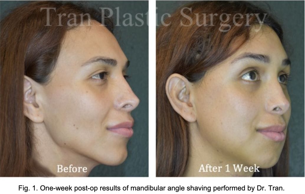 Jaw Reshaping - Tran Plastic Surgery