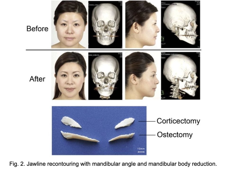 Jaw Reshaping - Tran Plastic Surgery